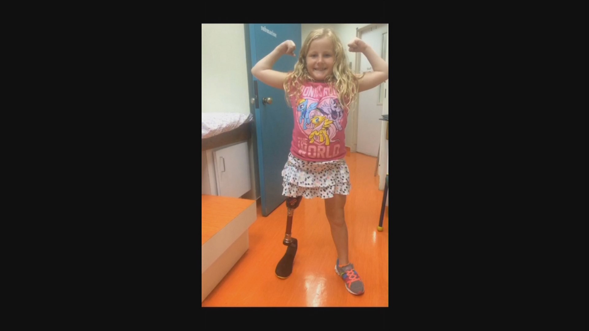 'Just like mine!': Little girl gets doll with prosthetic leg in viral ...
