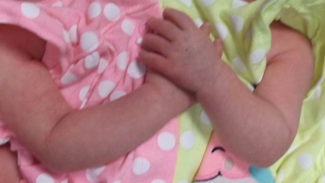 Conjoined twins thrive in NICU at Texas Children's | khou.com